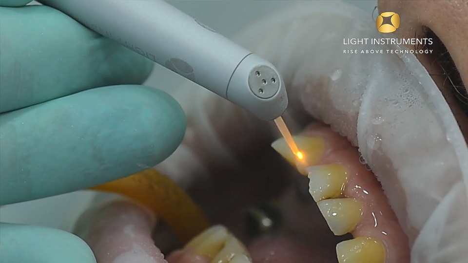 Laser Technology In Dentistry at Carly Decosta blog