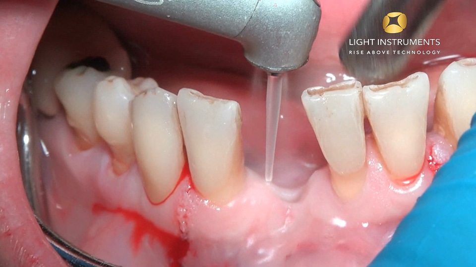 Implantology treatment with the LiteTouch™ | Light Instruments Ltd.