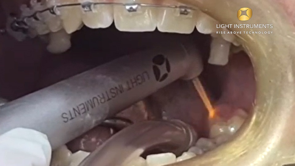 Oral Surgery with the LiteTouch™ Er:YAG | Light Instruments Ltd.