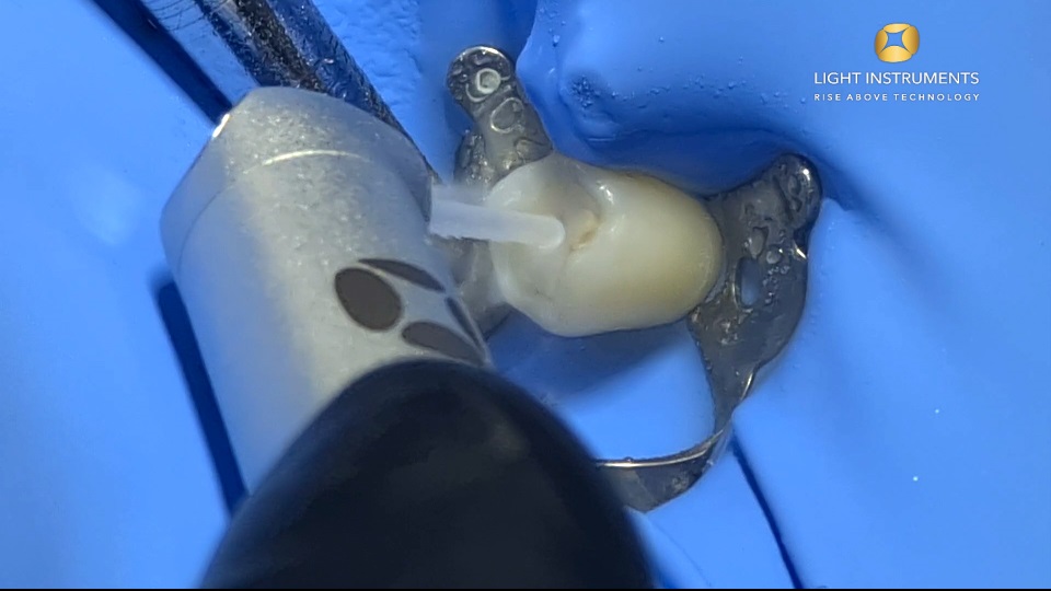 Restorative Dentistry with the LiteTouch™ Er:YAG | Light Instruments Ltd.